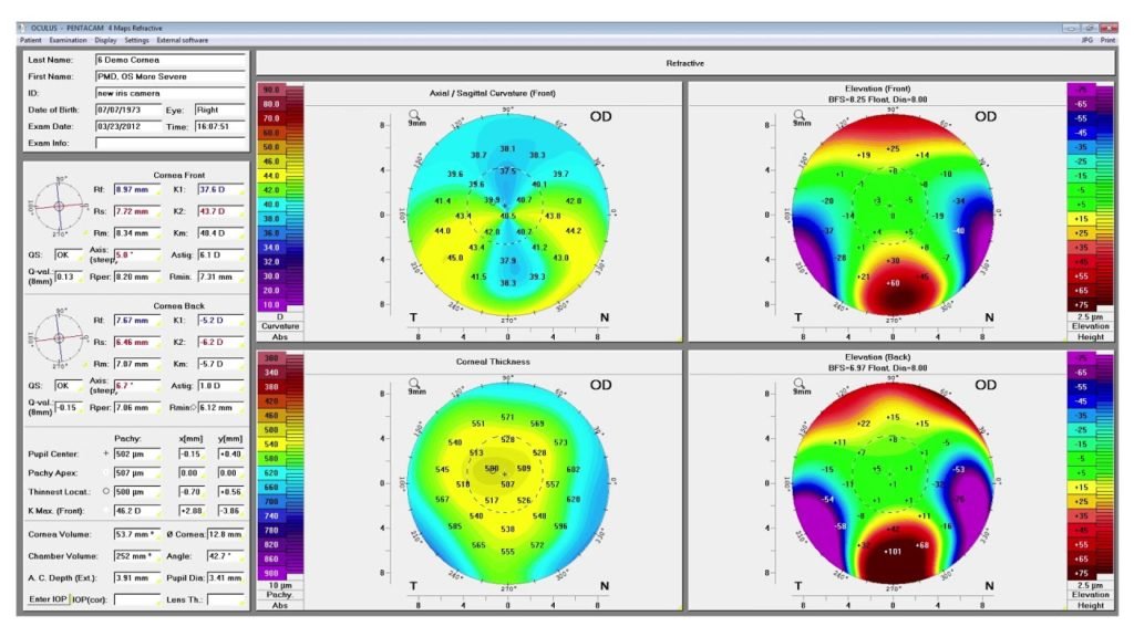 Equipments – Cornea