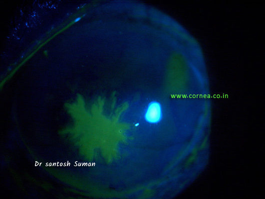 Dendrites – Cornea