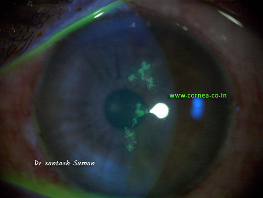 Dendrites – Cornea