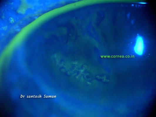 Dendrites – Cornea