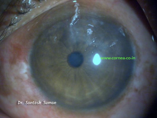 Corneal Findings – Cornea