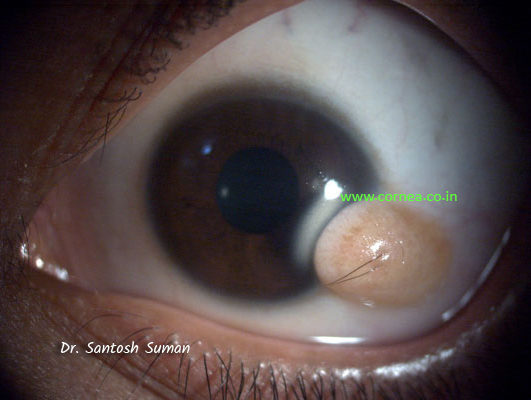 Corneal Findings – Cornea